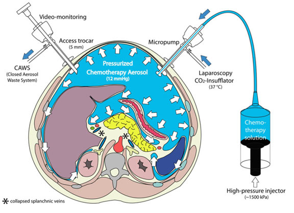 PIPAC (Pressurized intraperitoneal aerosol chemotherapy) | PD Dr ...